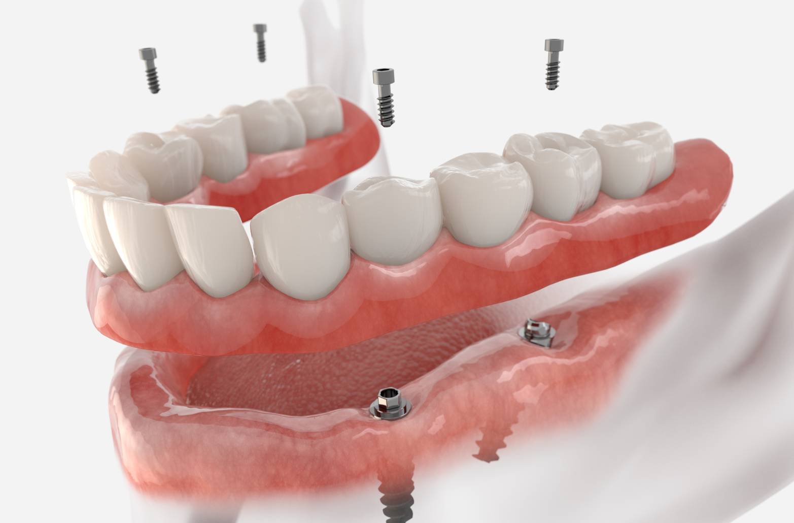 All-on-4 Dental implants in Turkey | FindGlob