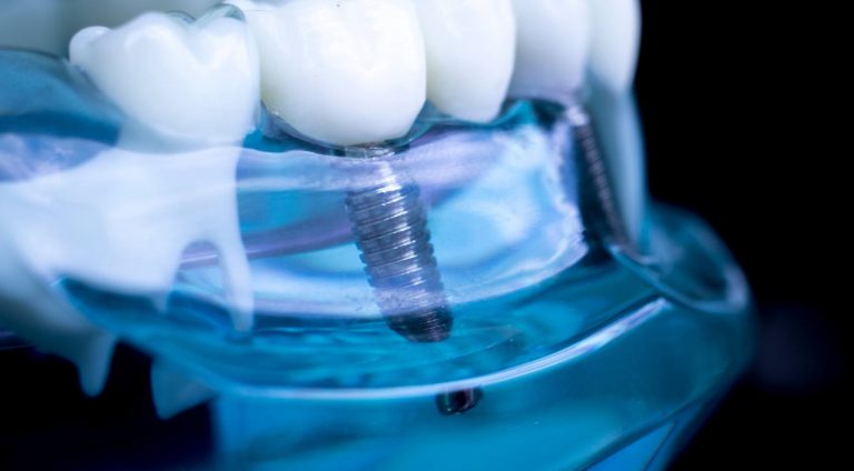 What are the alternatives to dental implants - FindGlob