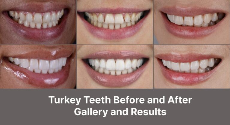 Turkey Teeth Before and After - FindGlob